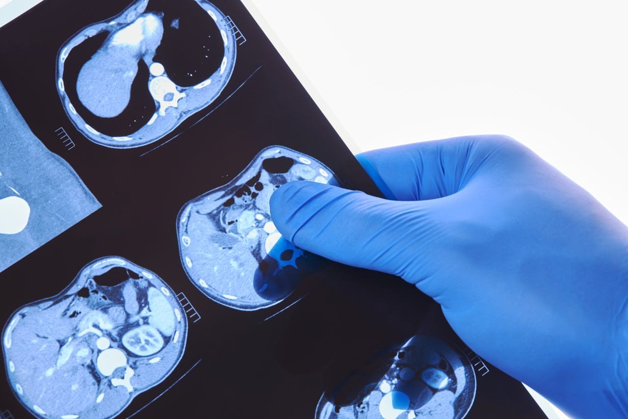 Full Body Screening For Early Detection of Cancer & Heart Disease